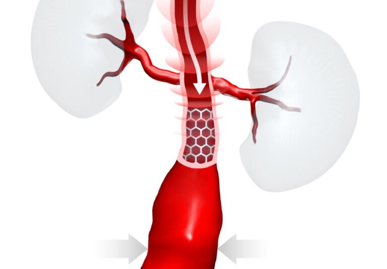 Angiolutions revolutionizes aortic aneurysm therapy